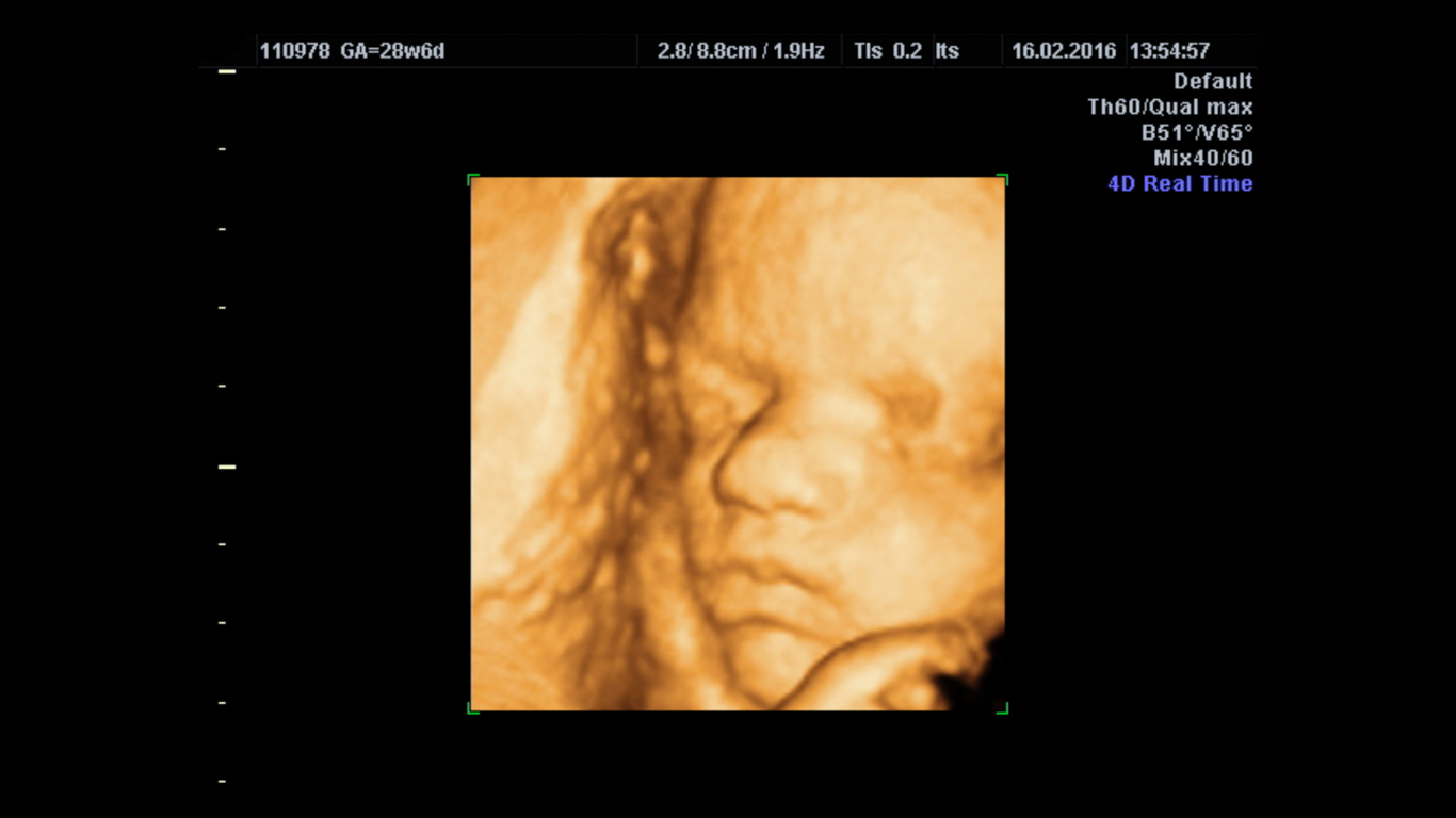 Ultrasound 2D - 5D | Rangkaian Klinik Tasik Puteri
